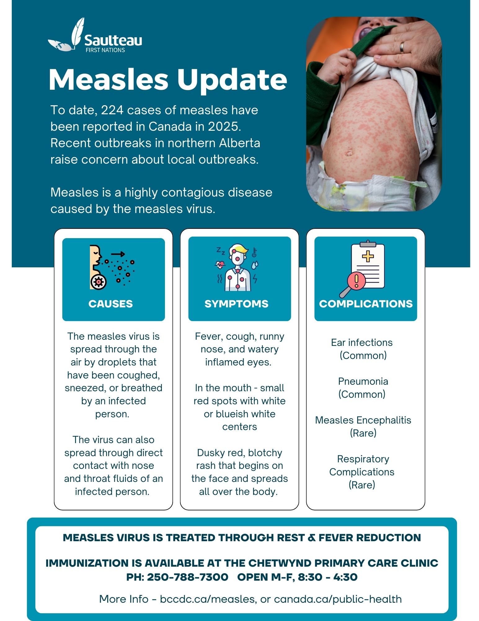 Measles Information for SFN Members - Saulteau First Nations